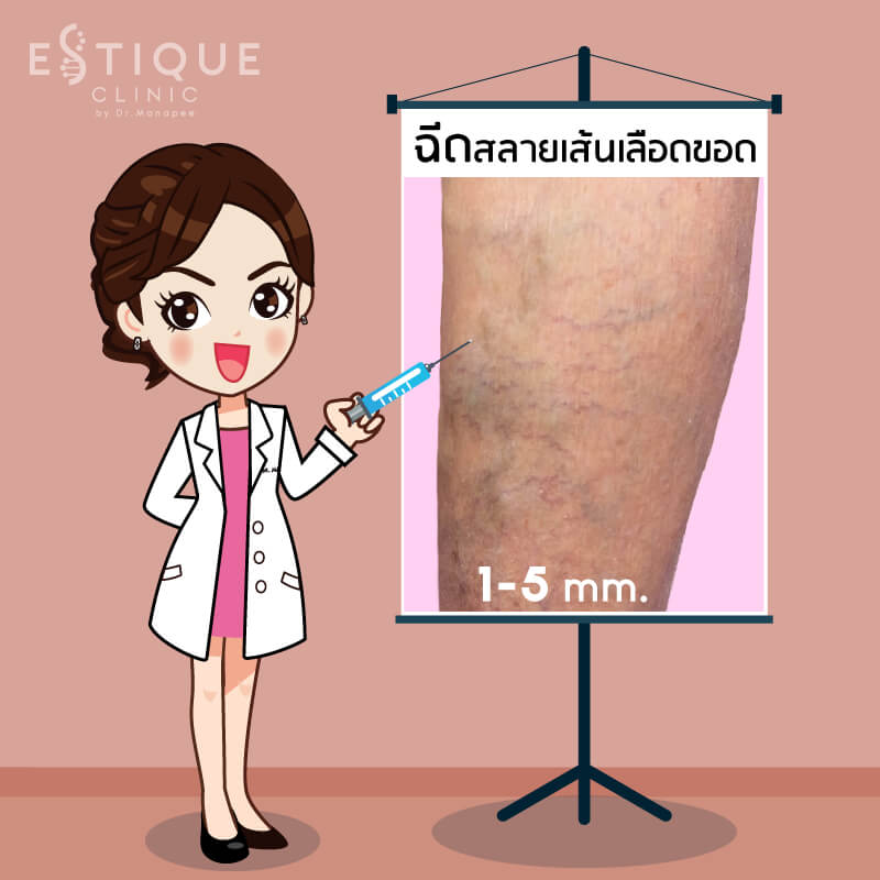 เส้นเลือดฝอยที่ขา รักษาได้หรือไม่ ต้องใช้วิธีไหนในการรักษา